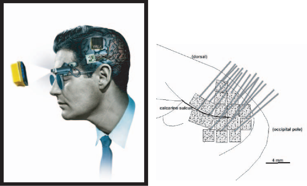 Intracortical Visual Prosthesis GKToday